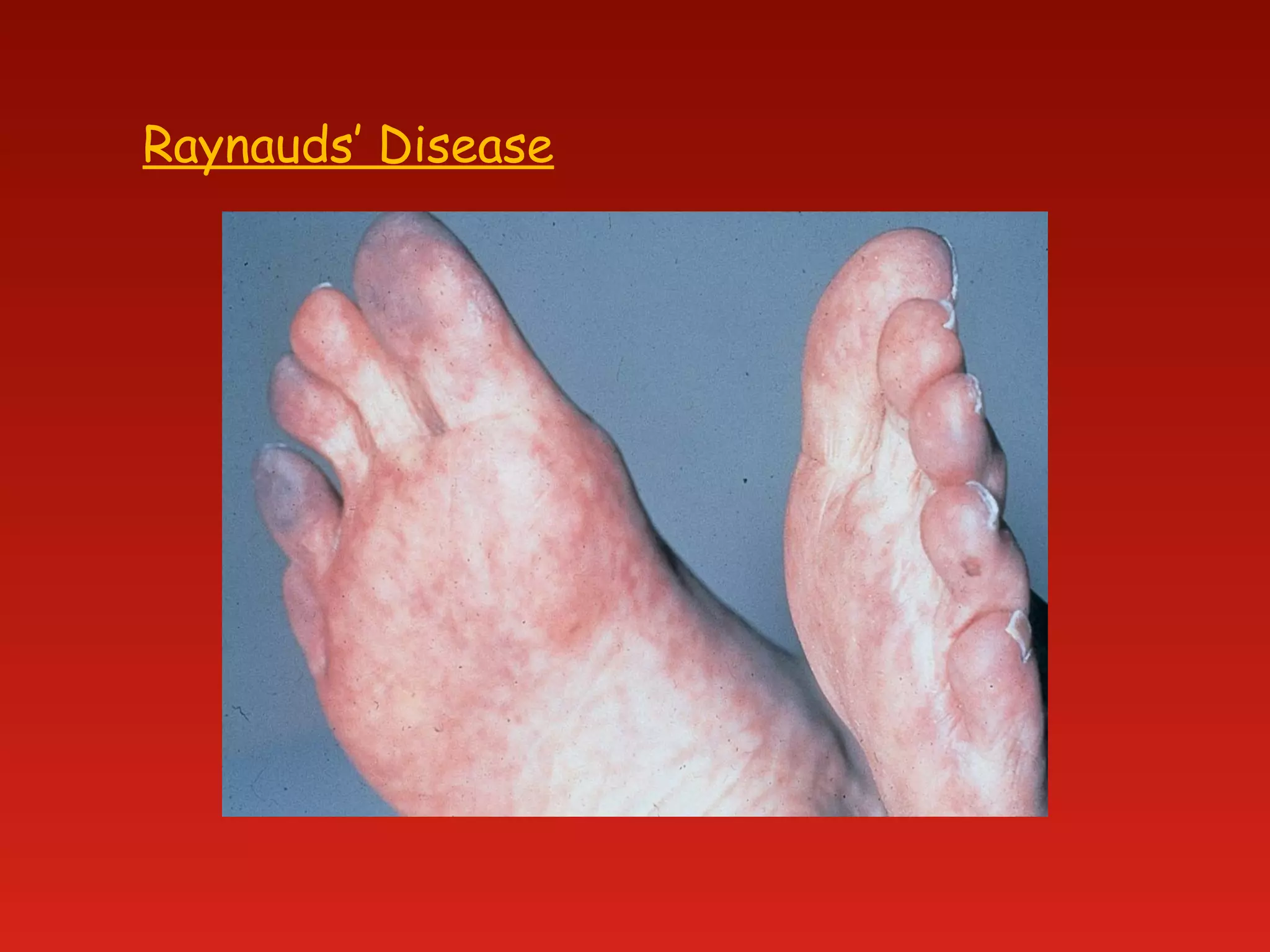 Peripheral vascular diseases | PPT