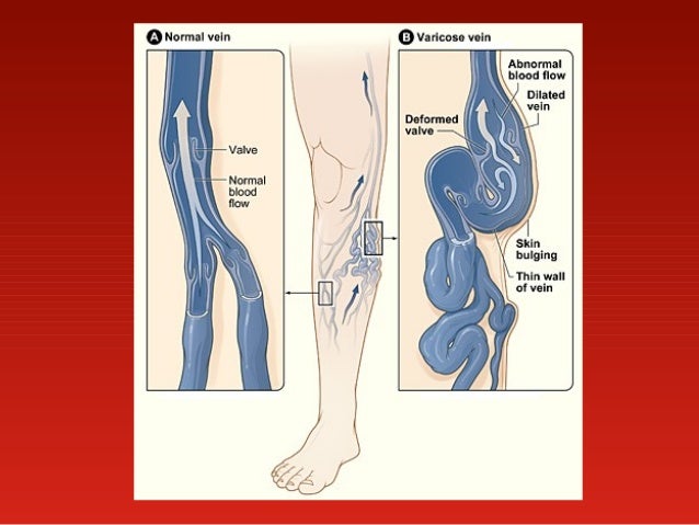 Peripheral vascular diseases