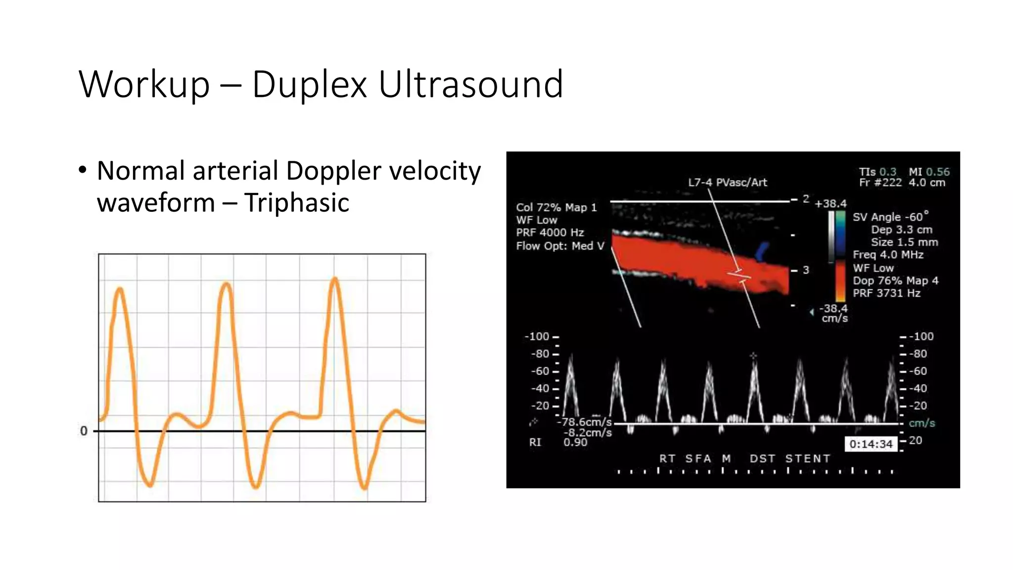 Peripheral vascular diseases | PPTX