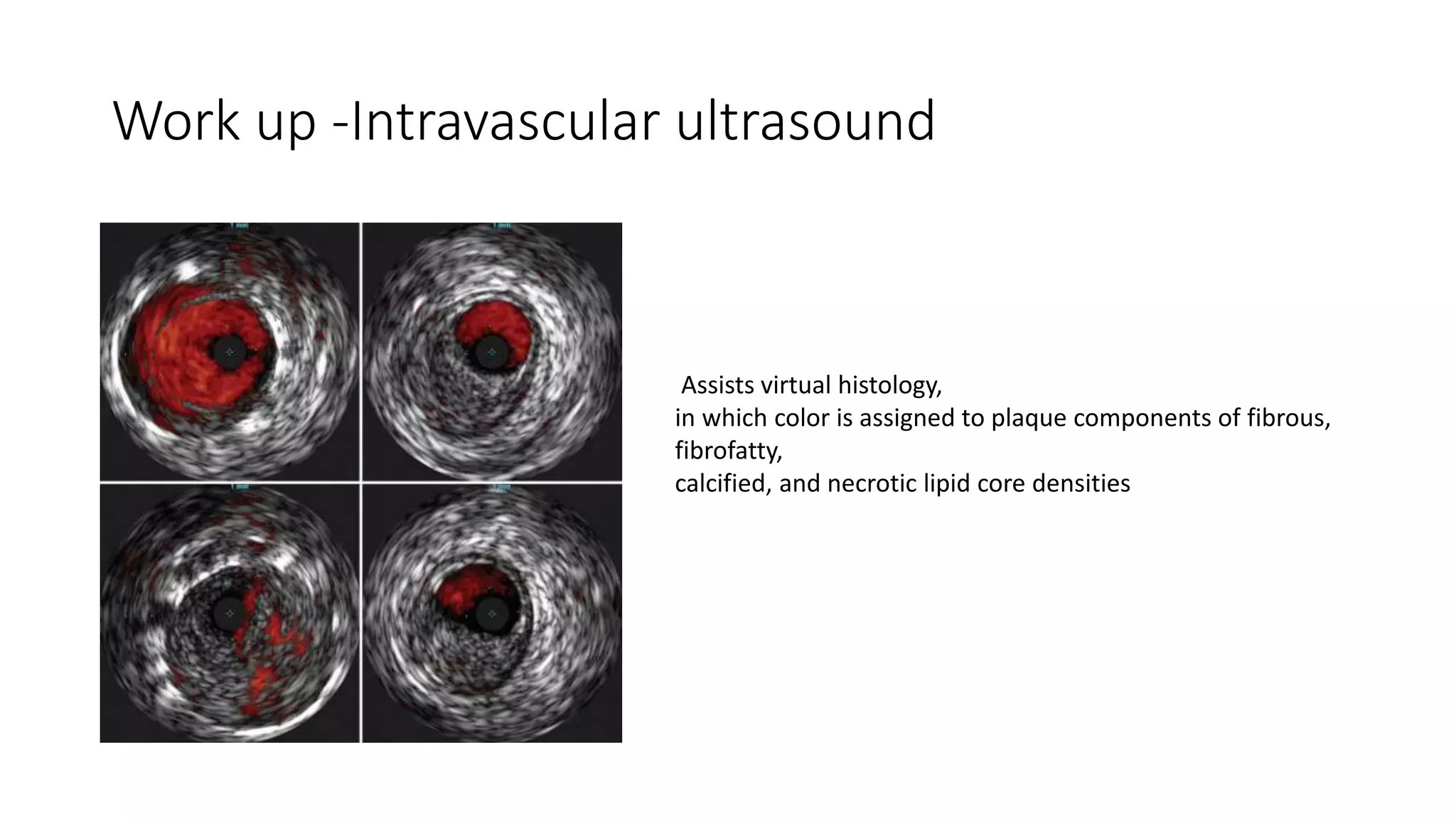 Peripheral vascular diseases | PPTX
