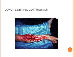 Peripheral Vascular Injuries | PPTX