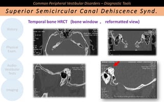 Peripheral vestibular disorders - Diagnostic tools | PDF