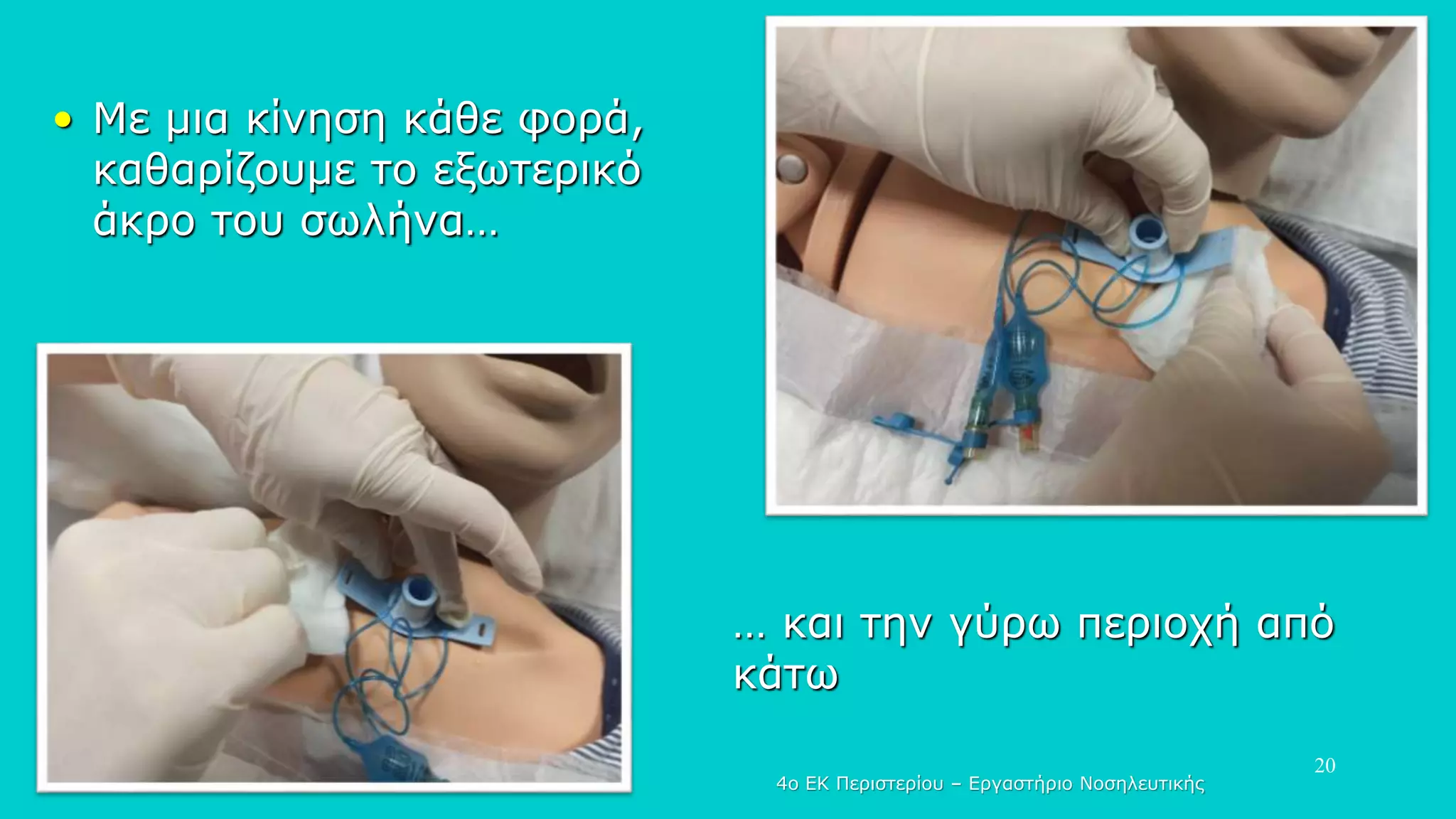 Φροντίδα τραχειοστομίας: Αλλαγή επιθέματος | PPTX