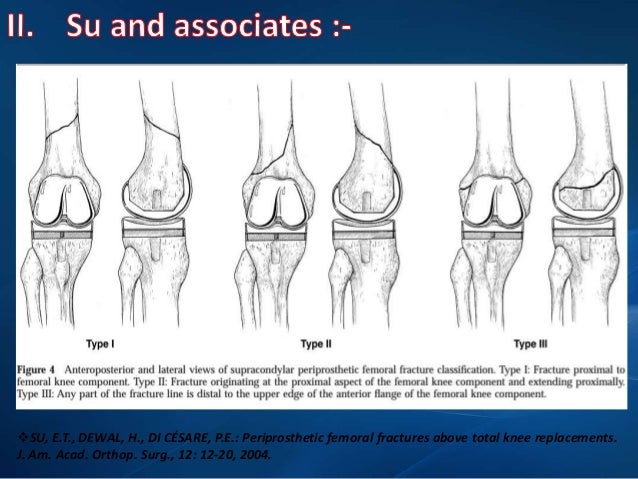 Periprosthetic fractures around the knee