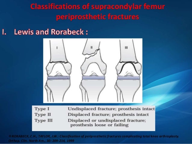 Periprosthetic fractures around the knee