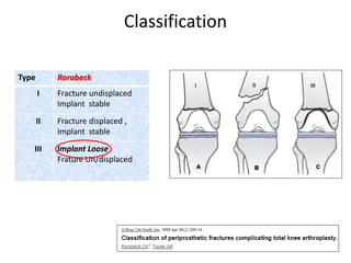 Periprosthetic fracture | PPTX