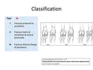 Periprosthetic fracture | PPTX