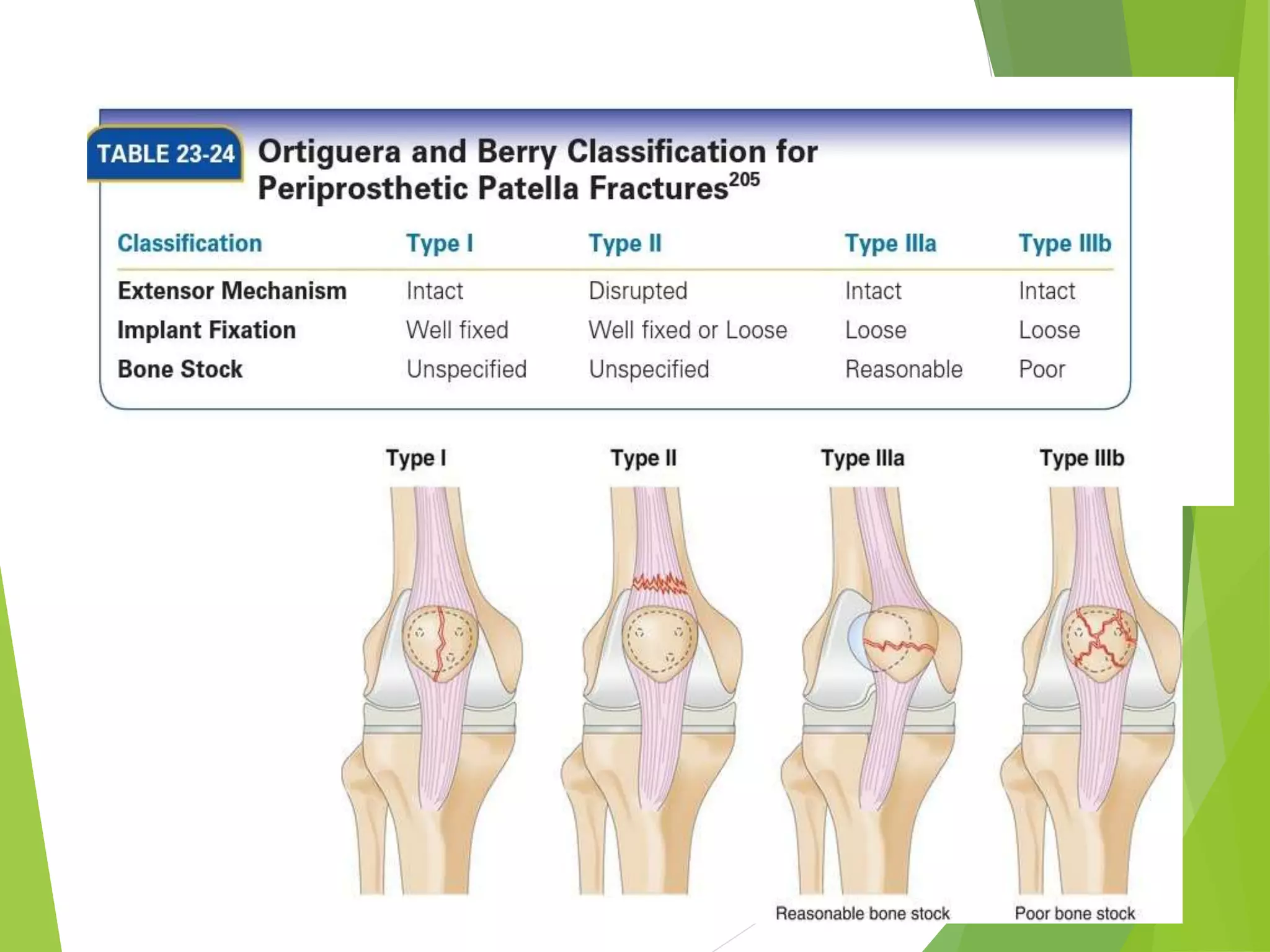 Peri prosthetic fracture | PPT