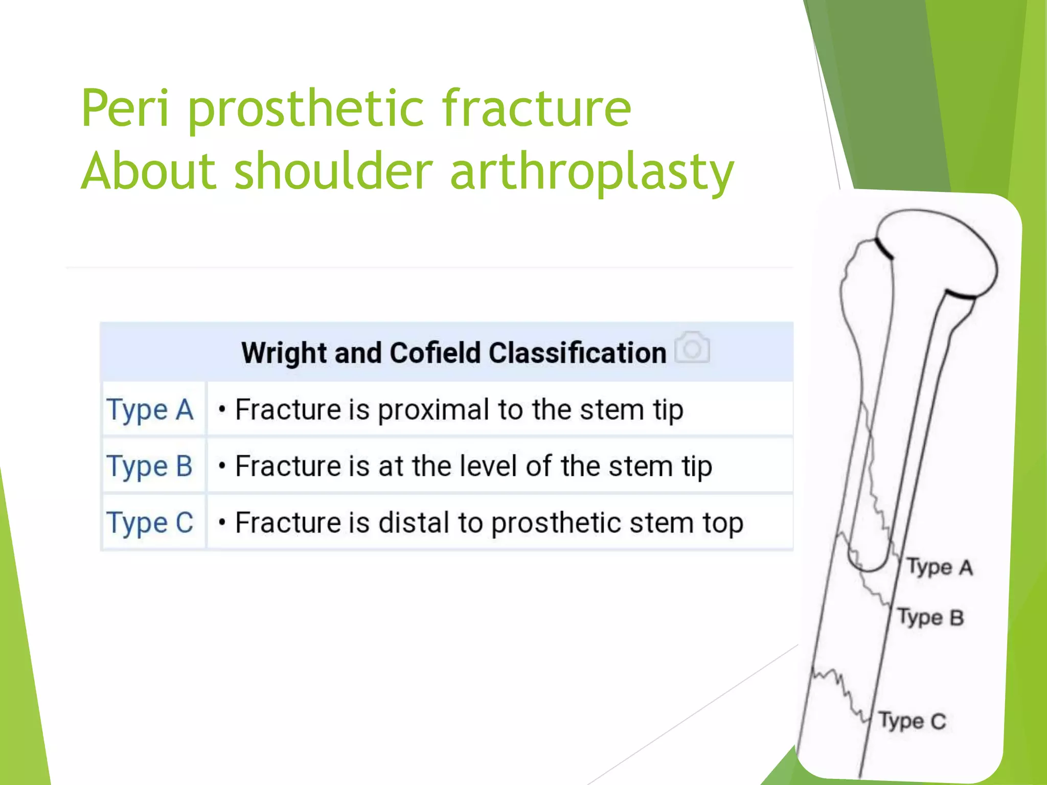 Peri prosthetic fracture | PPT