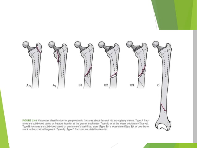Peri prosthetic fracture | PPT
