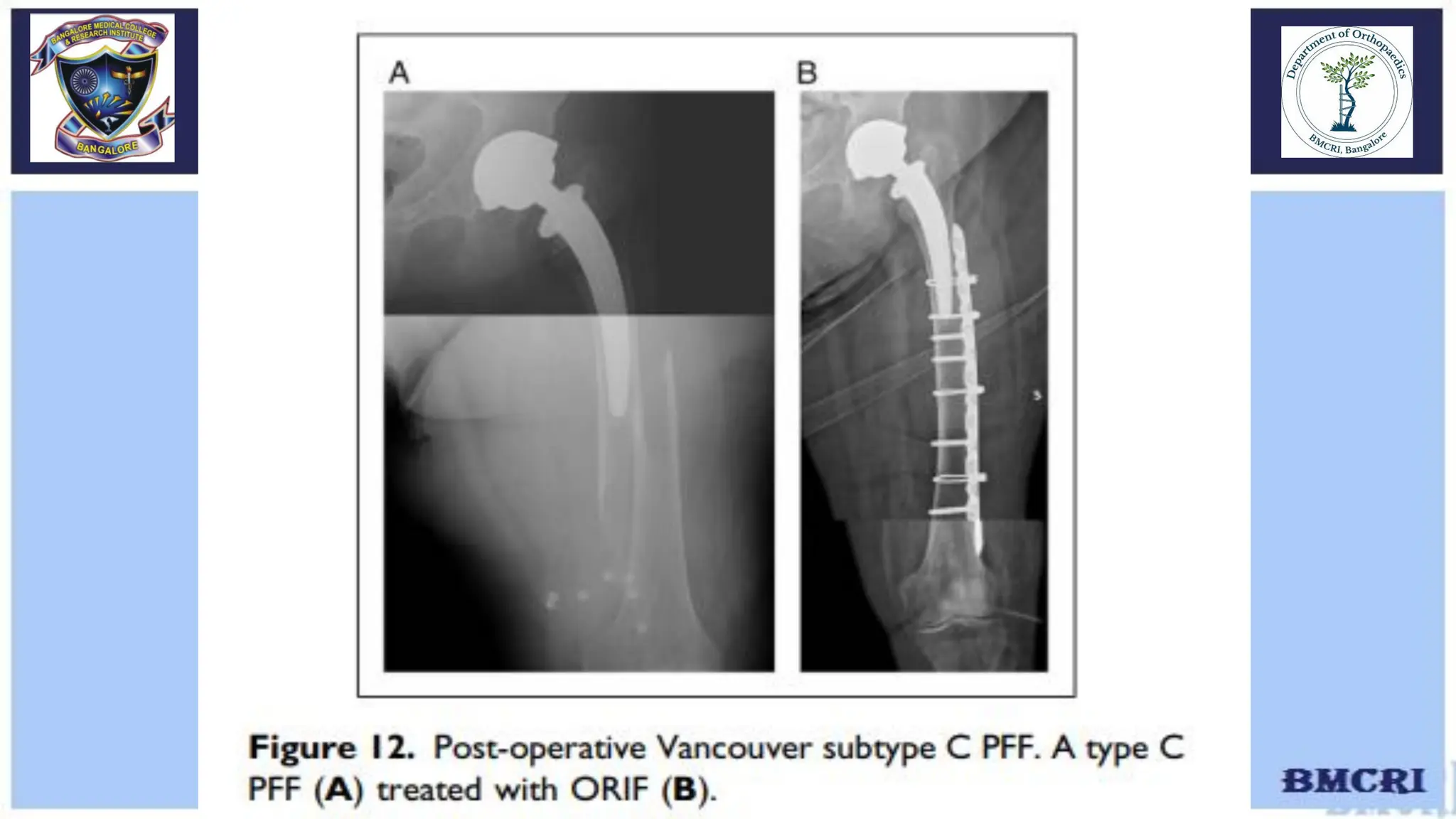 periprosthetic fracture around proximal femur | PDF
