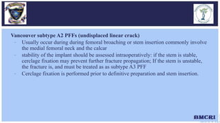 periprosthetic fracture around proximal femur | PPT
