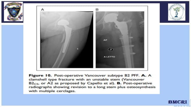 periprosthetic fracture around proximal femur | PPT
