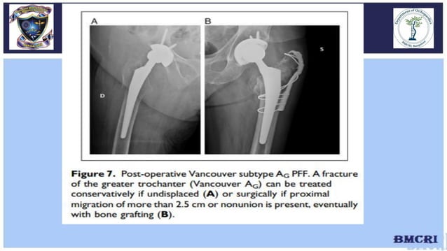 periprosthetic fracture around hio prosthesis | PDF