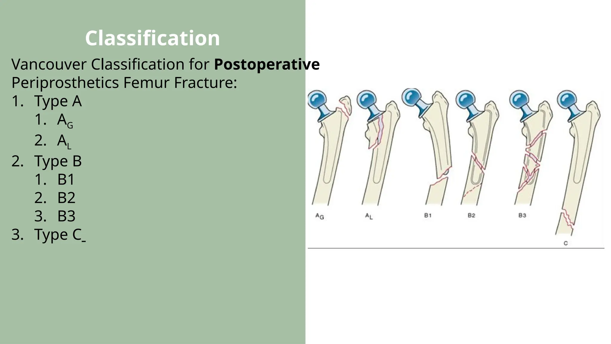 Periprosthetic Fracture for adul hip and knee reconstruction | PPTX