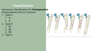 Periprosthetic Fracture for adul hip and knee reconstruction | PPT