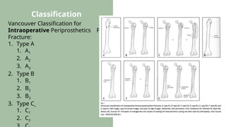 Periprosthetic Fracture for adul hip and knee reconstruction | PPT