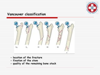 Periprosthetic fractures | PPTX