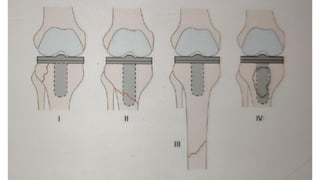 Peri prosthetic fractures.pptx.......... | PPT