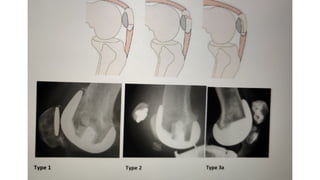 Peri prosthetic fractures.pptx.......... | PPT