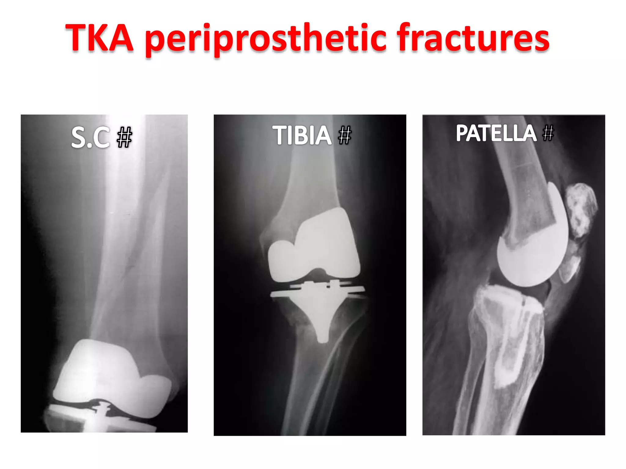 Periprosthetic fractures of knee | PPTX
