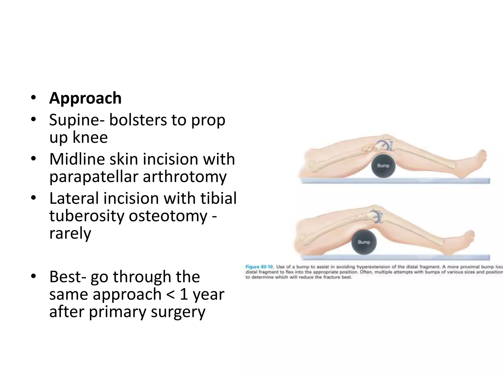 Periprosthetic fractures of knee | PPTX