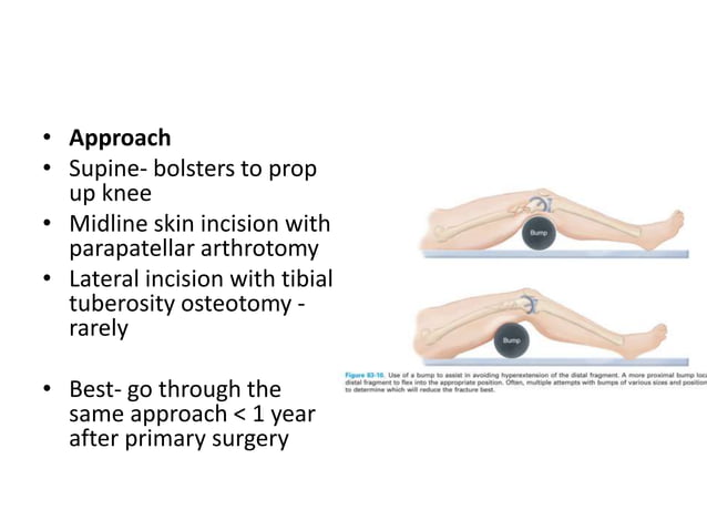 Periprosthetic fractures of knee | PPTX | Death, Injury, or Military ...