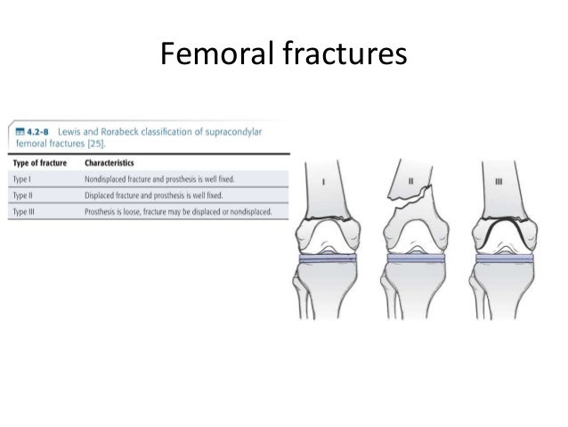 Periprosthetic fractures of knee