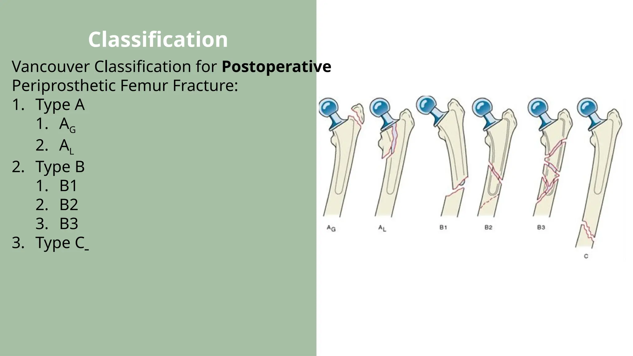 Periprosthetic fractures (PF) are considered fractures associated with ...