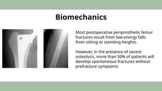 Periprosthetic fractures (PF) are considered fractures associated with ...