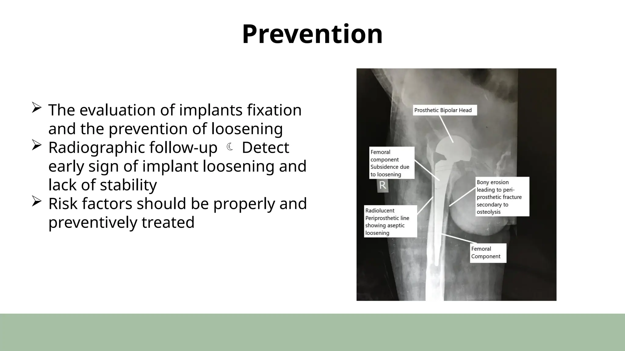 Periprosthetic Fracture (Updated) (2).pptx