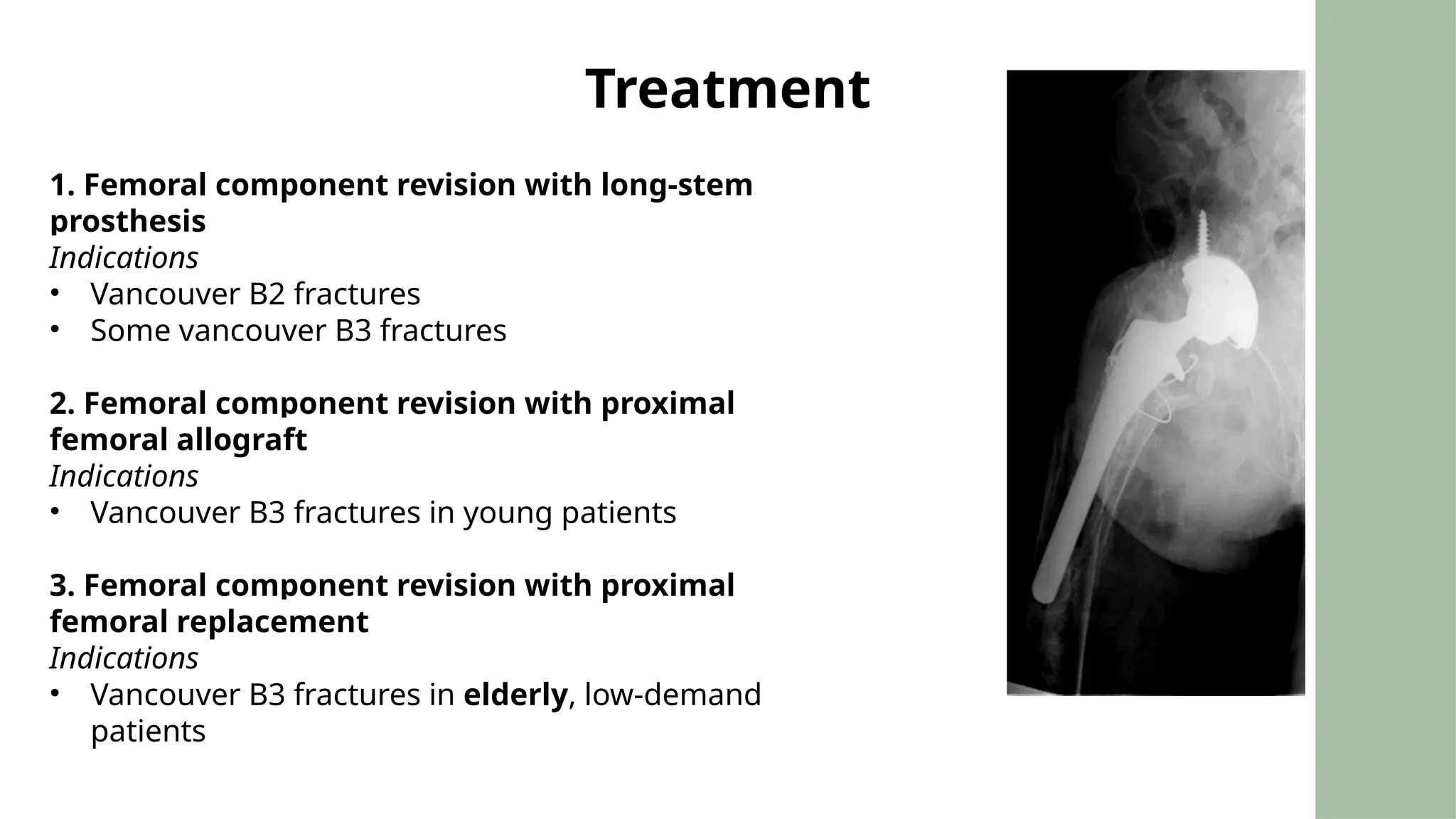 Periprosthetic Fracture (Updated) (2).pptx