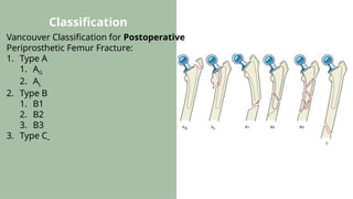 Periprosthetic Fracture (Updated) (2).pptx