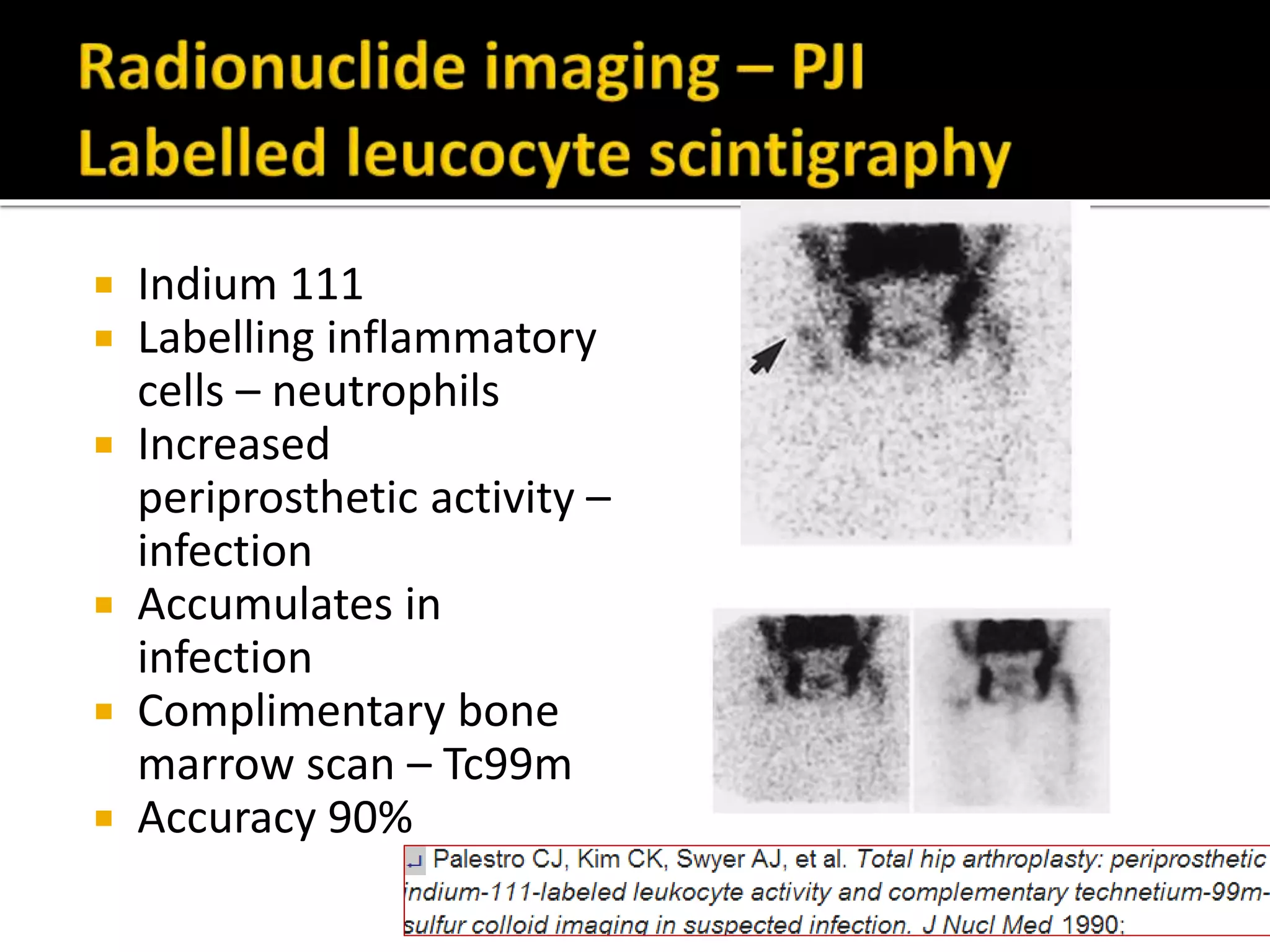 Periprosthetic joint infection | PPTX