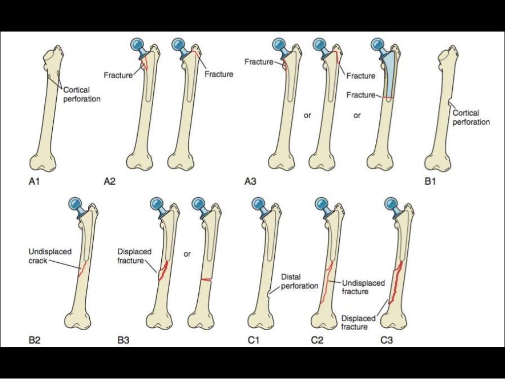 Periprosthetic Fractures of Hip - basics & tips & tricks!