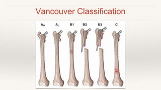 Periprothetic fractures of the hip & knee | PPTX