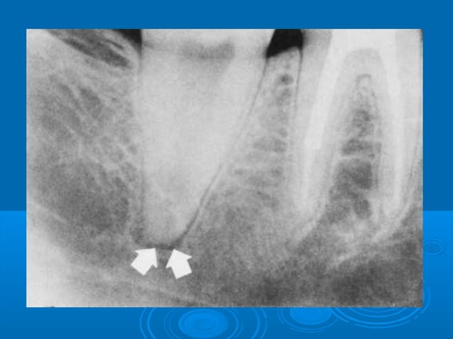 Periradicular lesions (1) | PPT