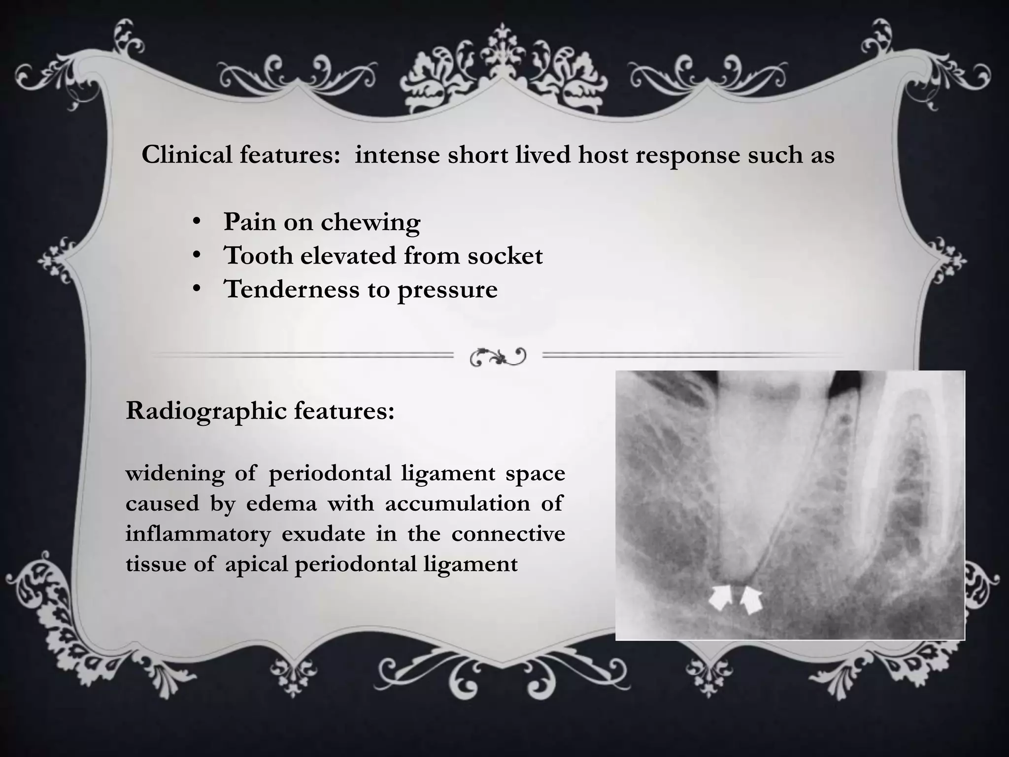 Periradicular Diseases | PPTX