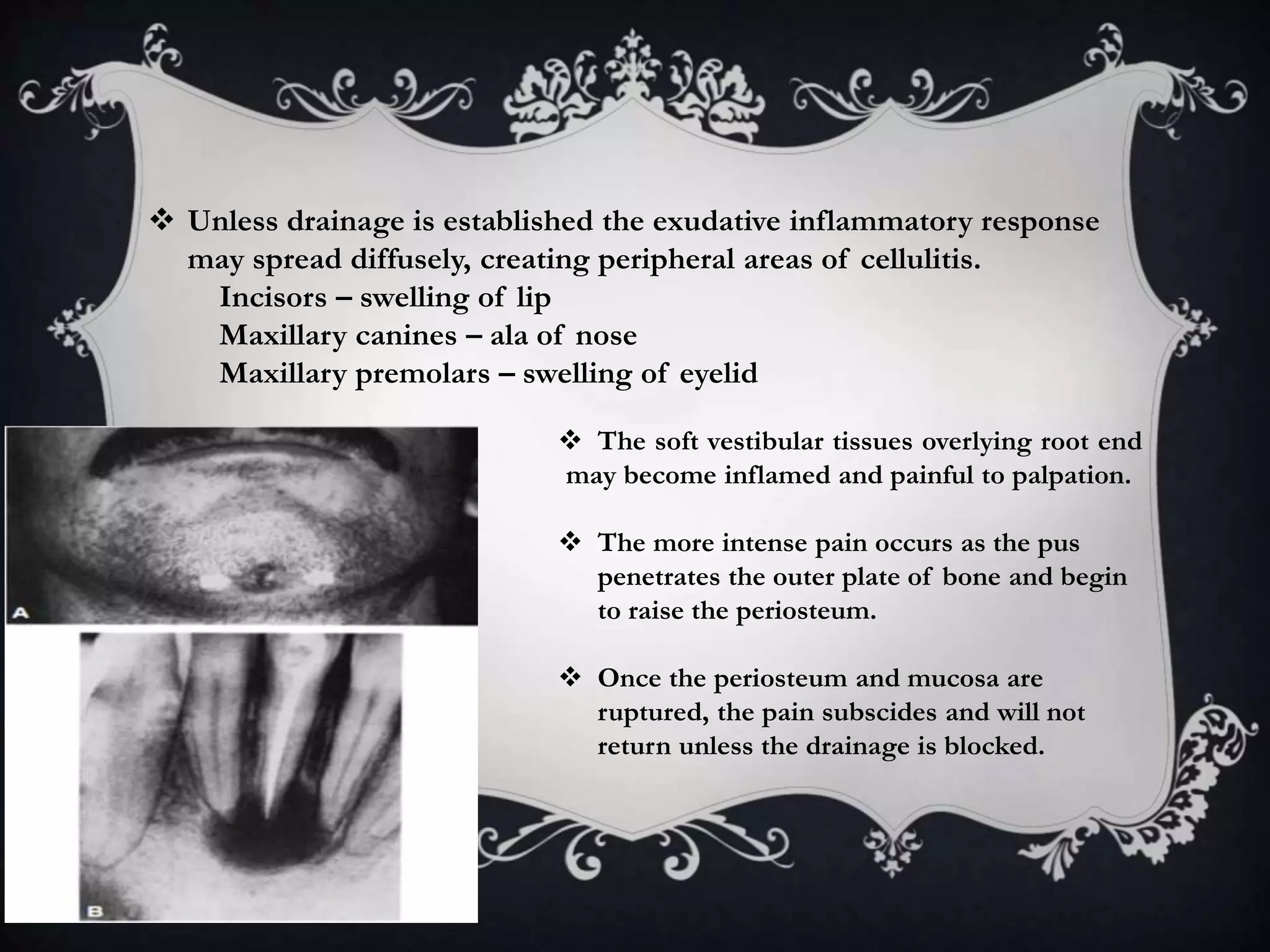 Periradicular Diseases | PPTX