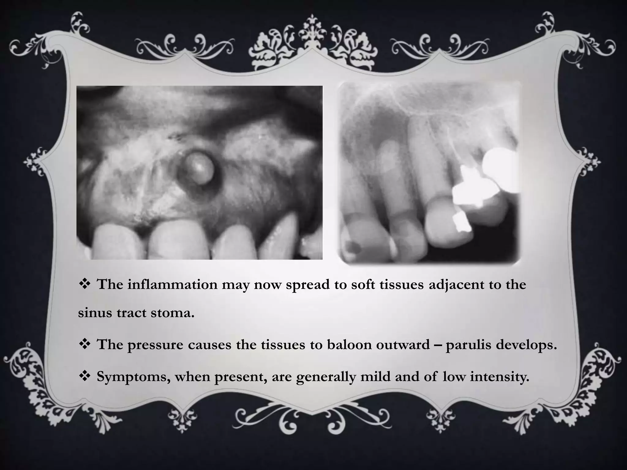 Periradicular Diseases | PPTX