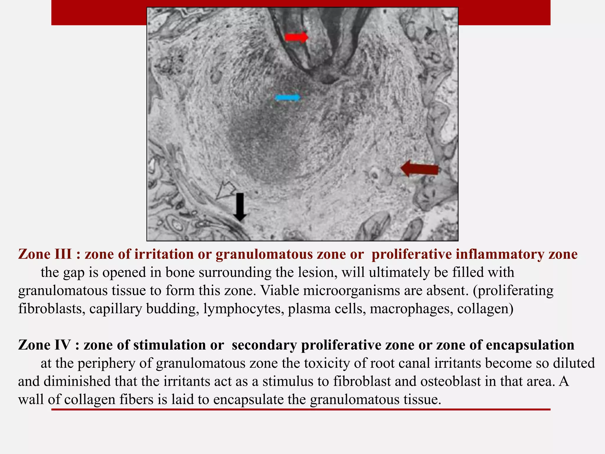 Periradicular Diseases | PPTX