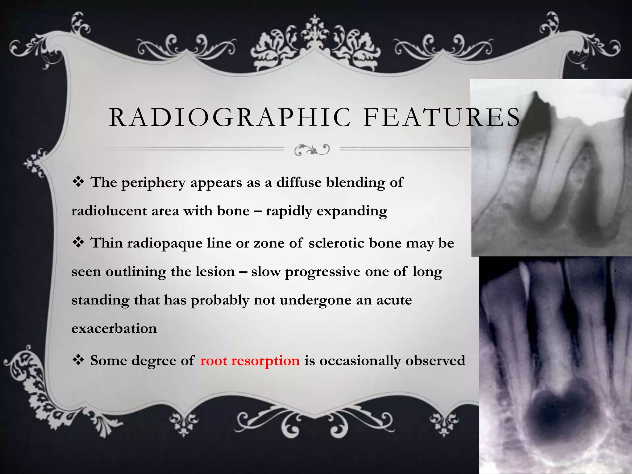 Periradicular Diseases | PPTX