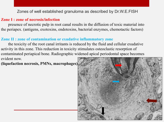 Periradicular Diseases | PPTX | Dental Health | Diseases and Conditions