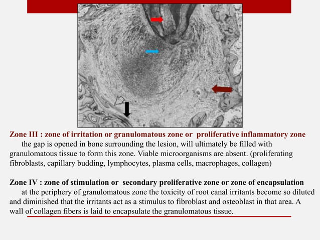 Periradicular Diseases | PPTX | Dental Health | Diseases and Conditions