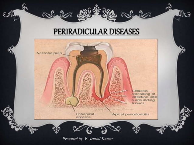 Periradicular Diseases | PPT