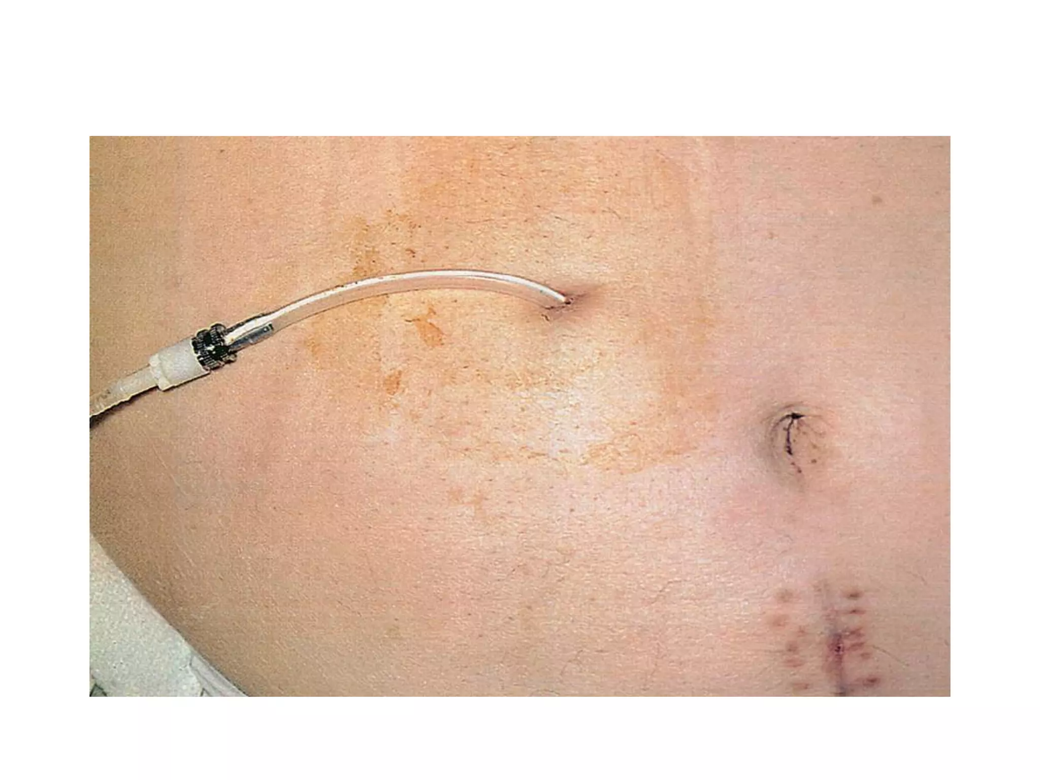 Periton diyalizi | PPTX