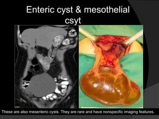 Imaging Of Peritoneal Pathology | PPTX