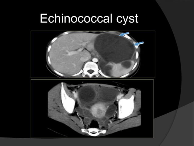 Imaging Of Peritoneal Pathology | PPTX