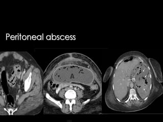 Imaging Of Peritoneal Pathology | PPTX
