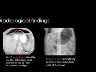 Imaging Of Peritoneal Pathology | PPTX